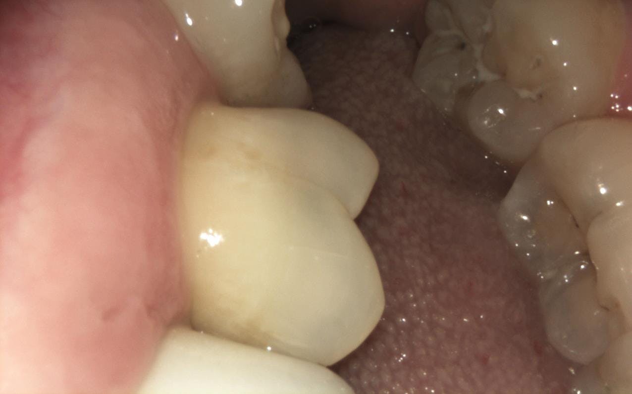 SDF application in the hands of a dental hygienist: 4 cases ...