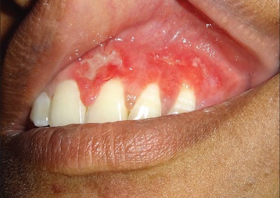 Differential diagnosis for periodontal pathologies for nonplaque ...
