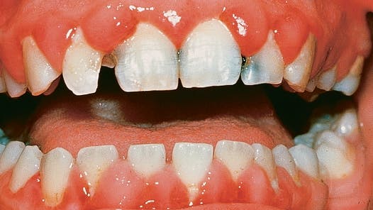 Bulging, bulbous, and boggy gingiva: A sign of more than just ...